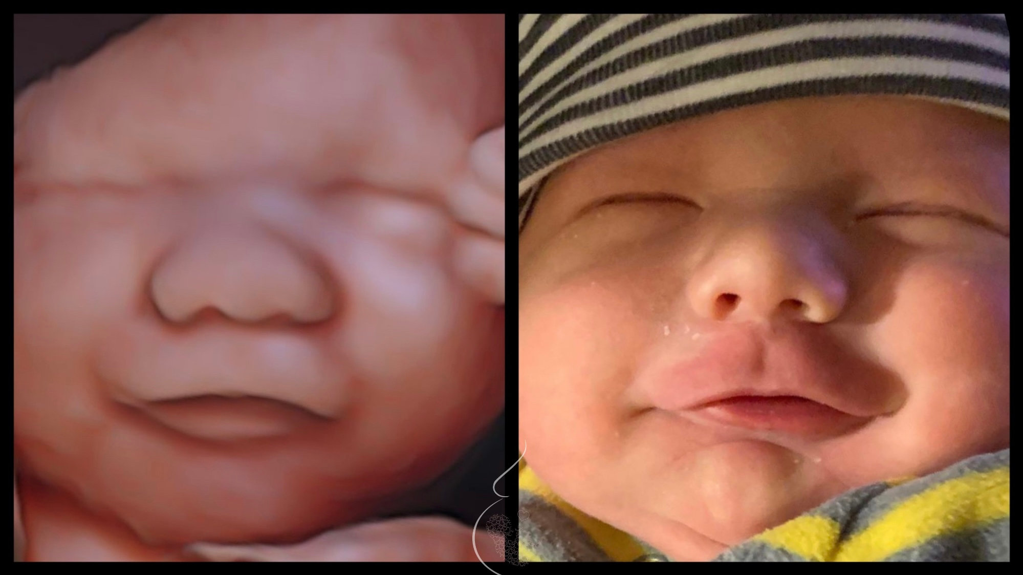 before & after - First Glimpse Ultrasound